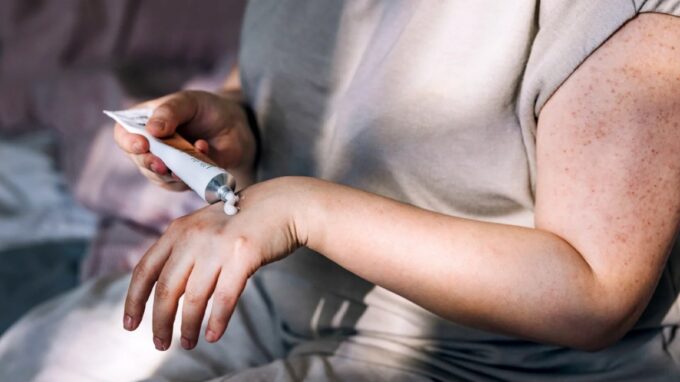 Topical Steroid Withdrawal: Understanding the Symptoms and Treatment ...